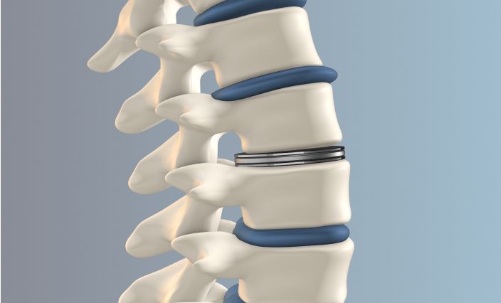 Disc Replacement Surgery - Atlas Orthopaedic Group