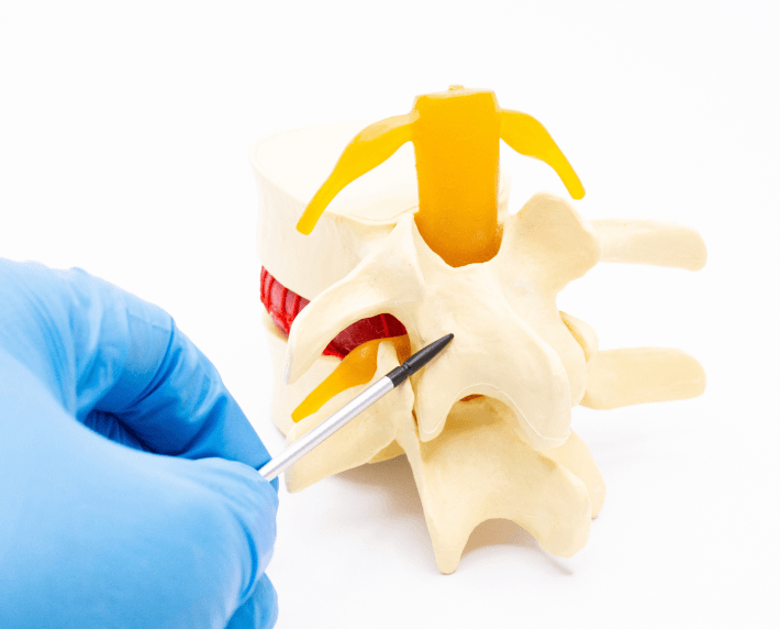 Laminectomy - Atlas Orthopaedic Group
